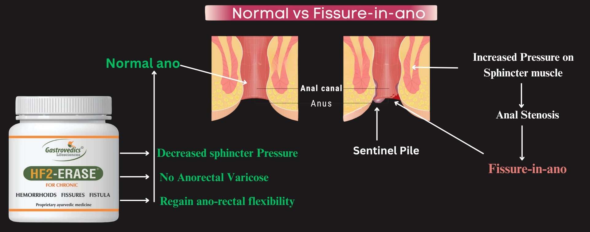 Fissures - Gastrovedics Fissure Ayurvedic treatment medicine in India